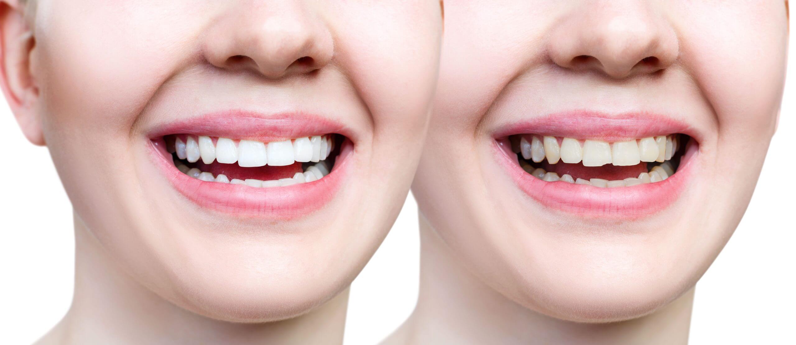 Chipped Teeth – from minor slightly chiped teeth to major breaks ...